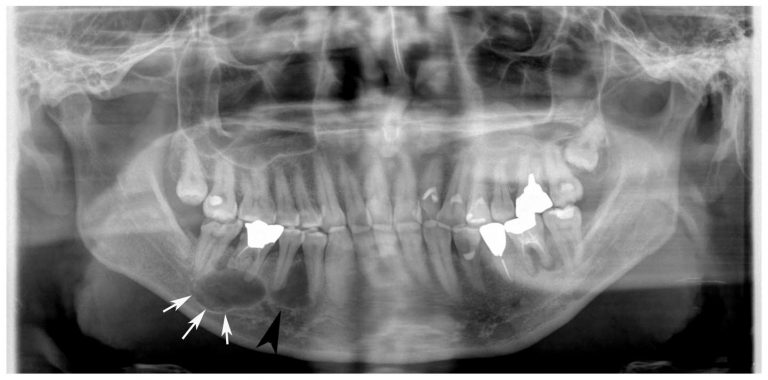 Jaw Tumors in the Inland Empire